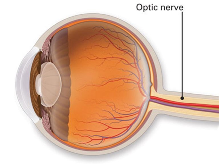 How the Optic Nerve Damage Causes Low Vision? - Zoomax Low Vision Aids